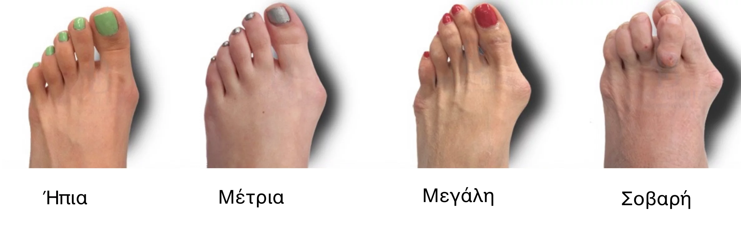 Κότσι Ποδιού (Βλαισός Μέγας Δάκτυλος) Διόρθωση | Κ. Σαράντος