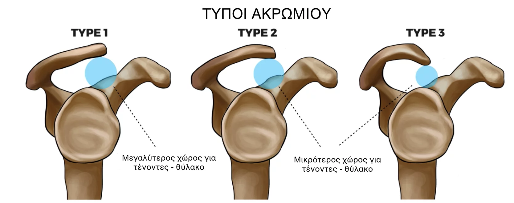 Τενοντίτιδα Ώμου (Υπερακανθίου): Αίτια - Θεραπεία | Κ. Σαράντος